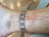 Hiker's rash: red rash between knee and ankle after hiking for several ...