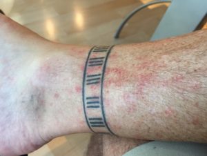 Hiker's rash: red rash between knee and ankle after hiking for several ...