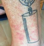 Hiker's rash: red rash between knee and ankle after hiking for several ...